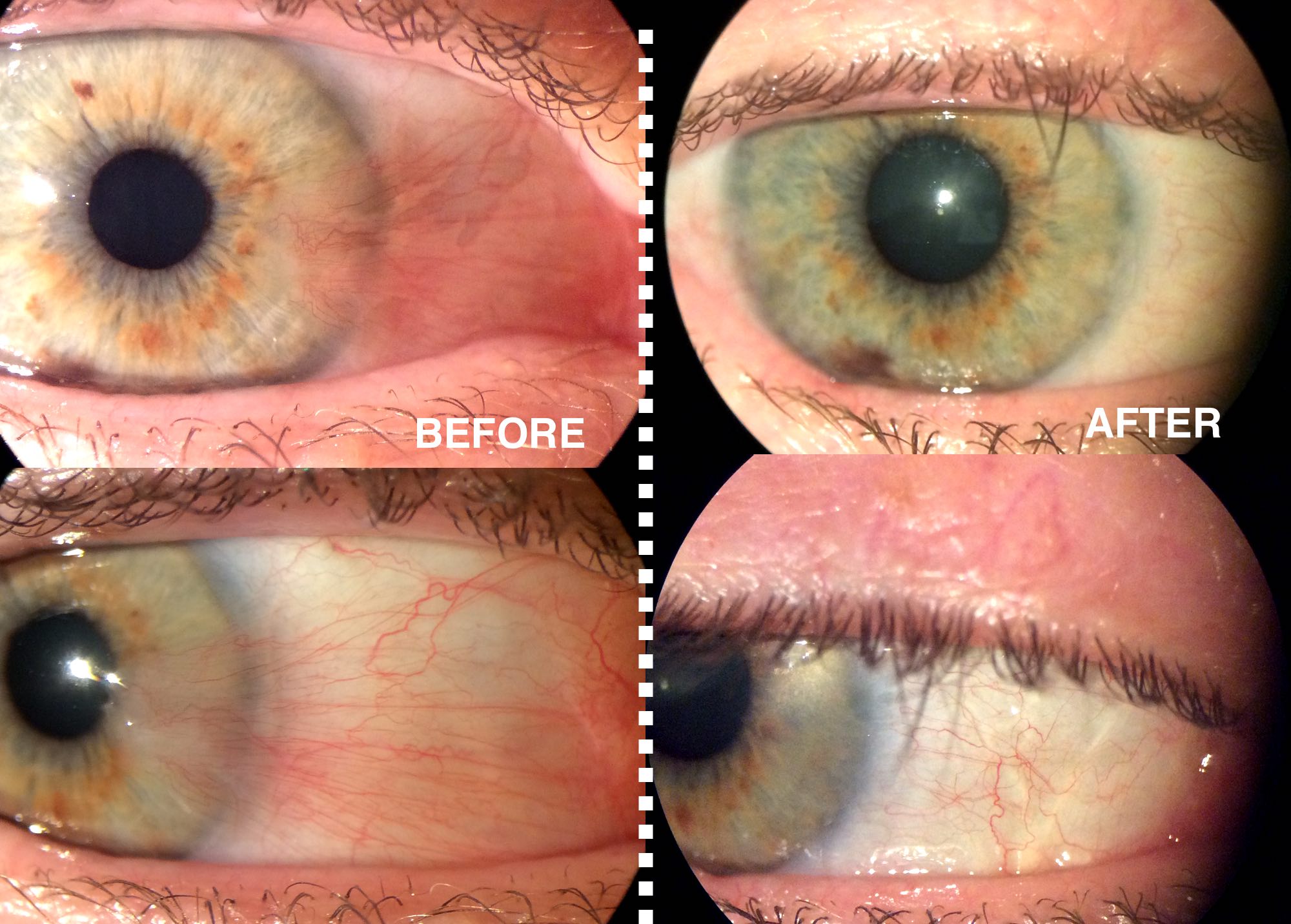 Pterygium Removal