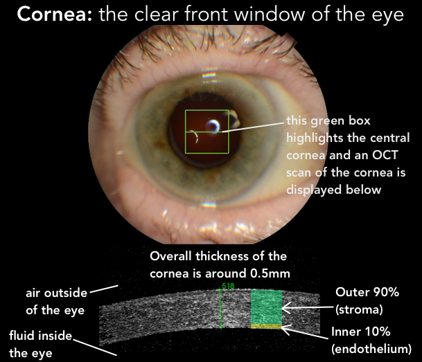 Corneal Transplant Rejection